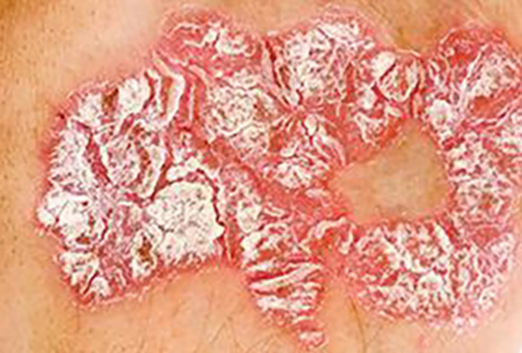 Do you have Plaque Psoriasis?
