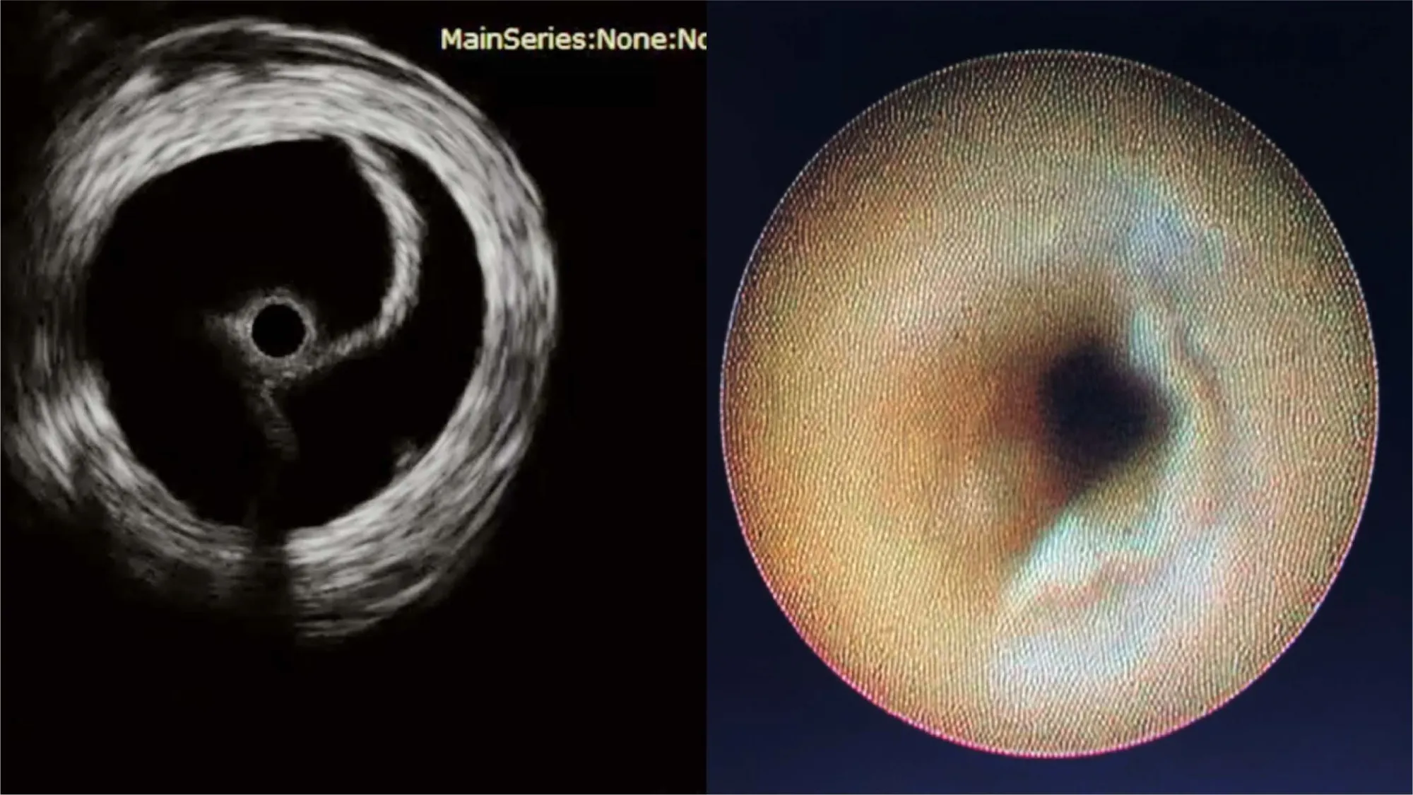Clinical Feasibility Study for Endovenous Deep Vein Valve Formation for ...